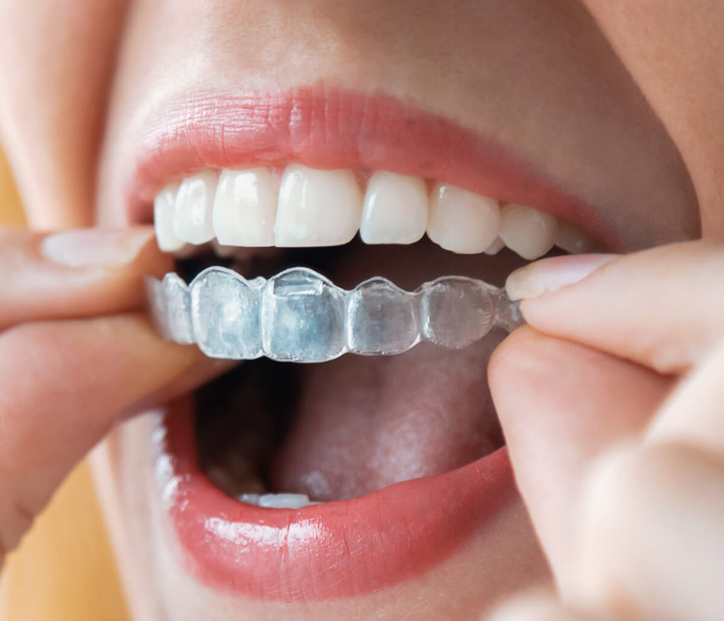 Are You a Good Candidate for Clear Correct Teeth Straightening ...